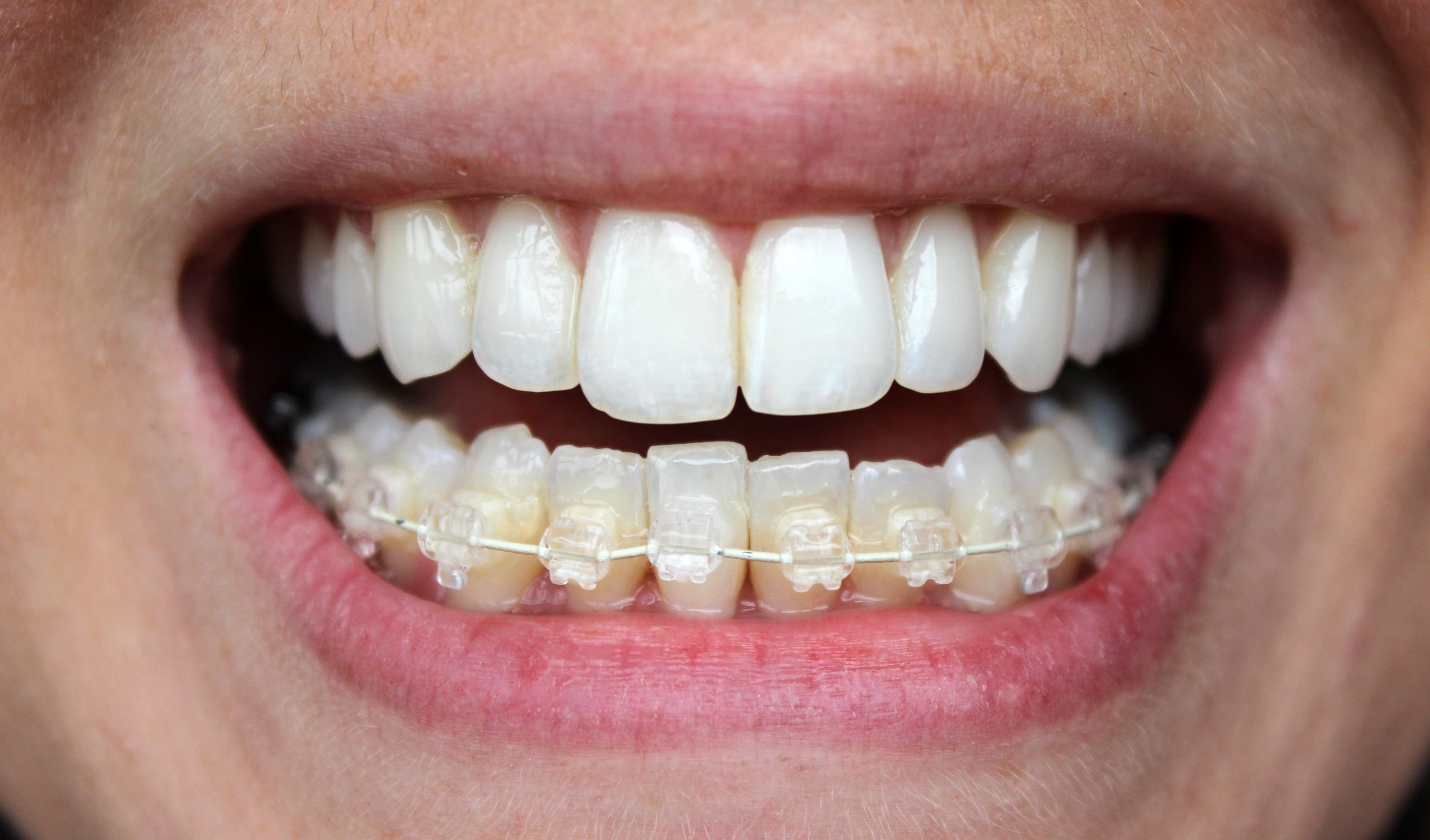 Six Month Smiles adult braces | xameliax | Health & beauty