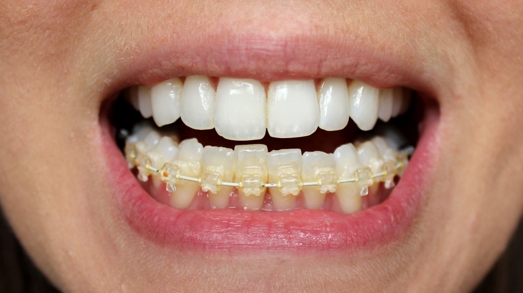 Six Month Smiles adult braces | xameliax | Health & beauty